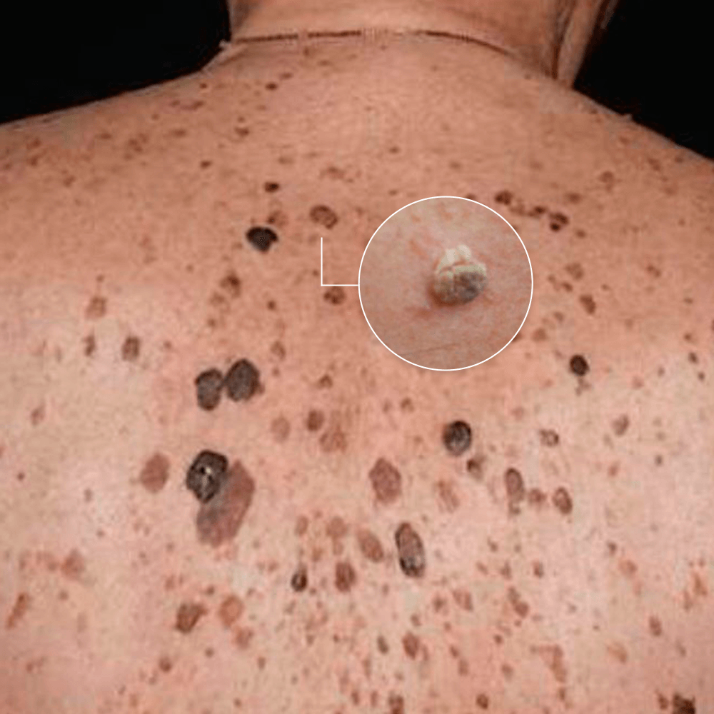 Ceratose Seborréica - Aline Bilemjian